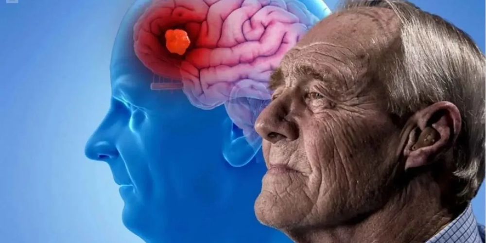 Hallazgo en el Alzheimer: el análisis de sangre que detecta la ...