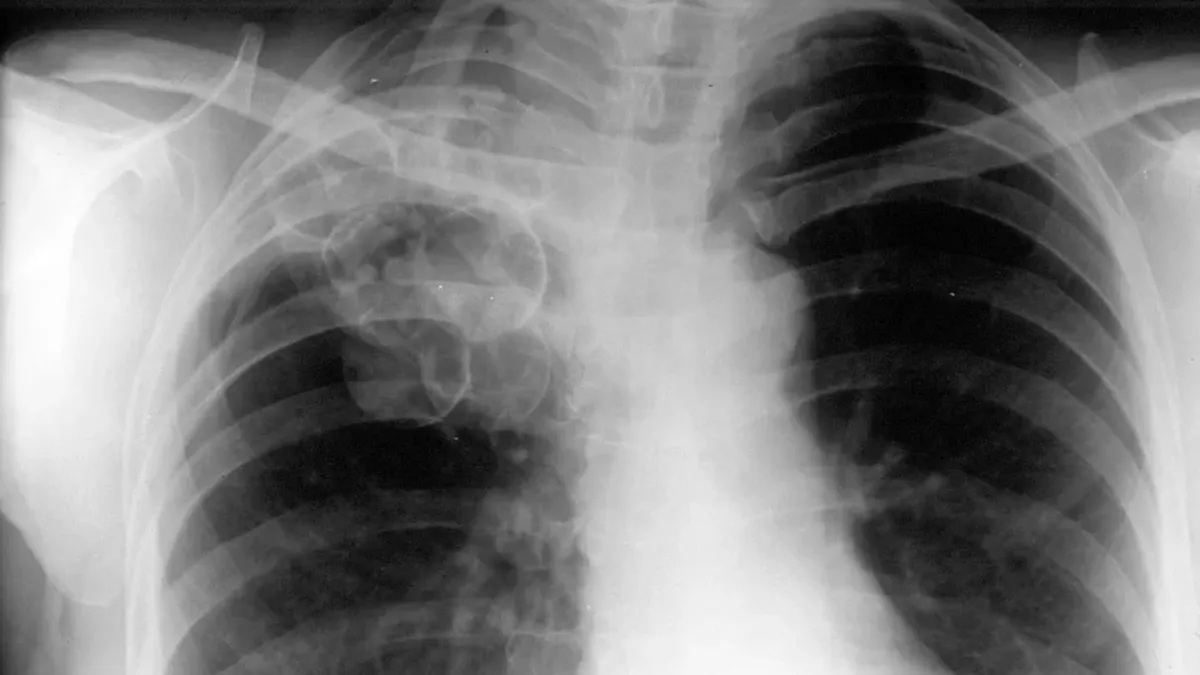 Cómo saber si la tos puede convertirse en tuberculosis y cómo prevenirla
