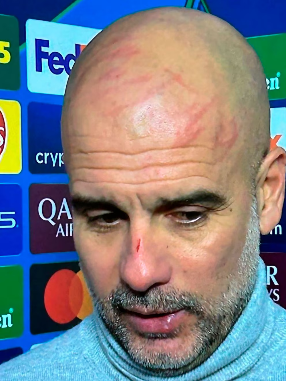 Guardiola aparece con arañazos tras el empate del City con el Feyenoord ...