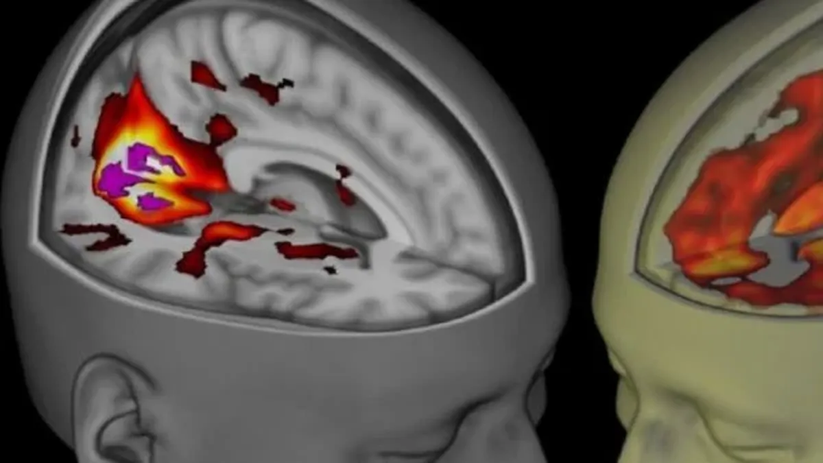 Así se reconecta el cerebro durante un viaje de LSD